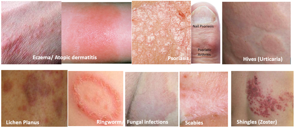 Skin Conditions causing Itching (Pruritis) or Rash