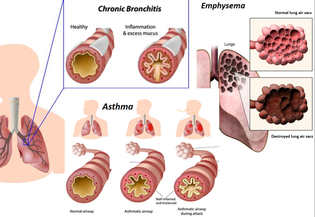 Asthma and Bronchitis are common respiratory conditions - Drvarsha