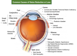 Vision Reduction and Loss - Understanding Causes and Points for Timely ...
