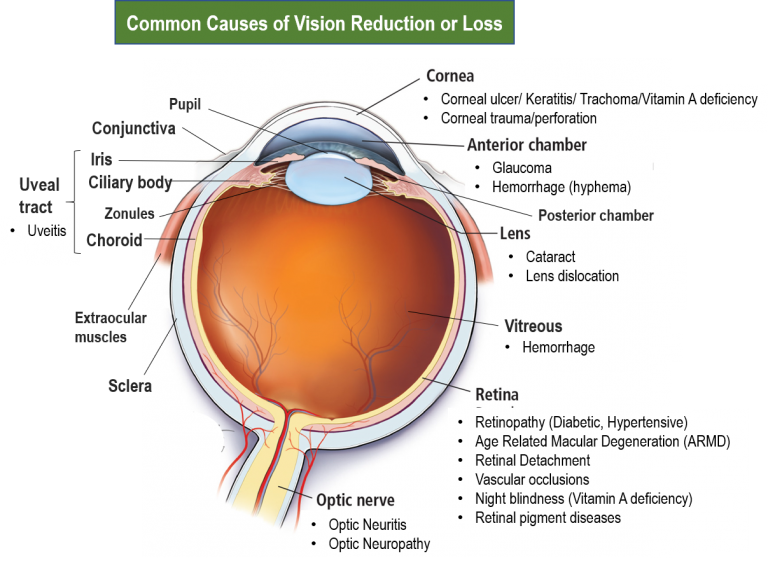 Vision Reduction and Loss - Understanding Causes and Points for Timely ...