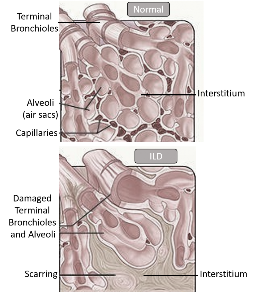 Interstitial Lung Disease ILD Types Risks And Health Measures