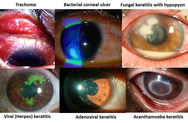 Red Eyes - Keratitis and Scleritis