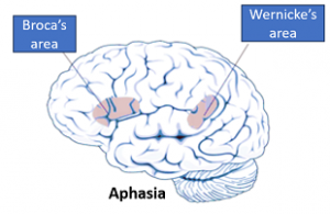 Aphasia: Understanding the Language Disorder