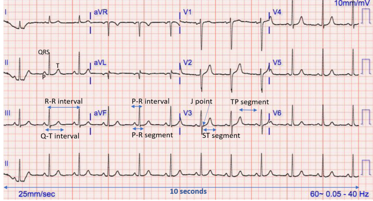 Understanding ECG – The Electrocardiogram