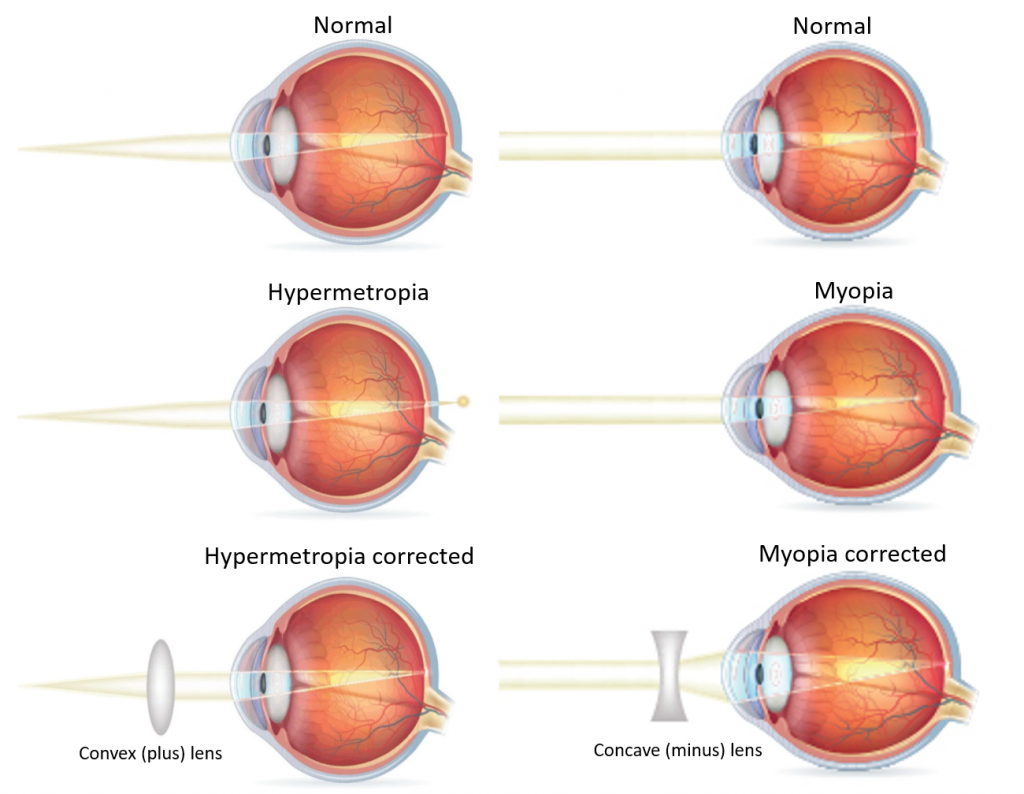 Refractive Errors - 5 Important Points