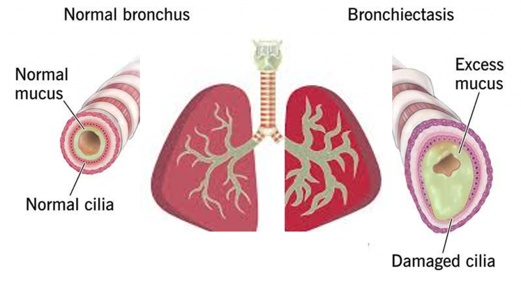 Bronchiectasis – Causes, Mechanism, Symptoms and Management